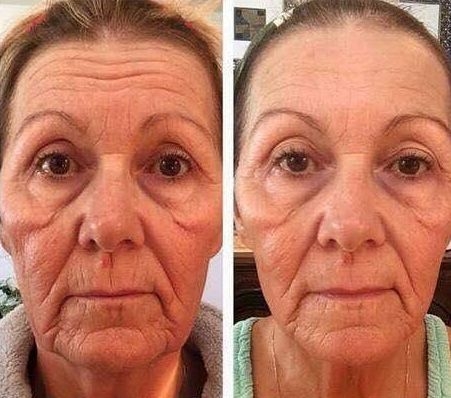 Eradicate Wrinkles And Flabby Face Skin With Facial Toning Workouts ...