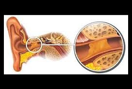 Patologías del Oído: Patologías del oído externo