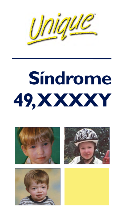 Un cariotipo extraordinario: Síndrome 49XXXXY