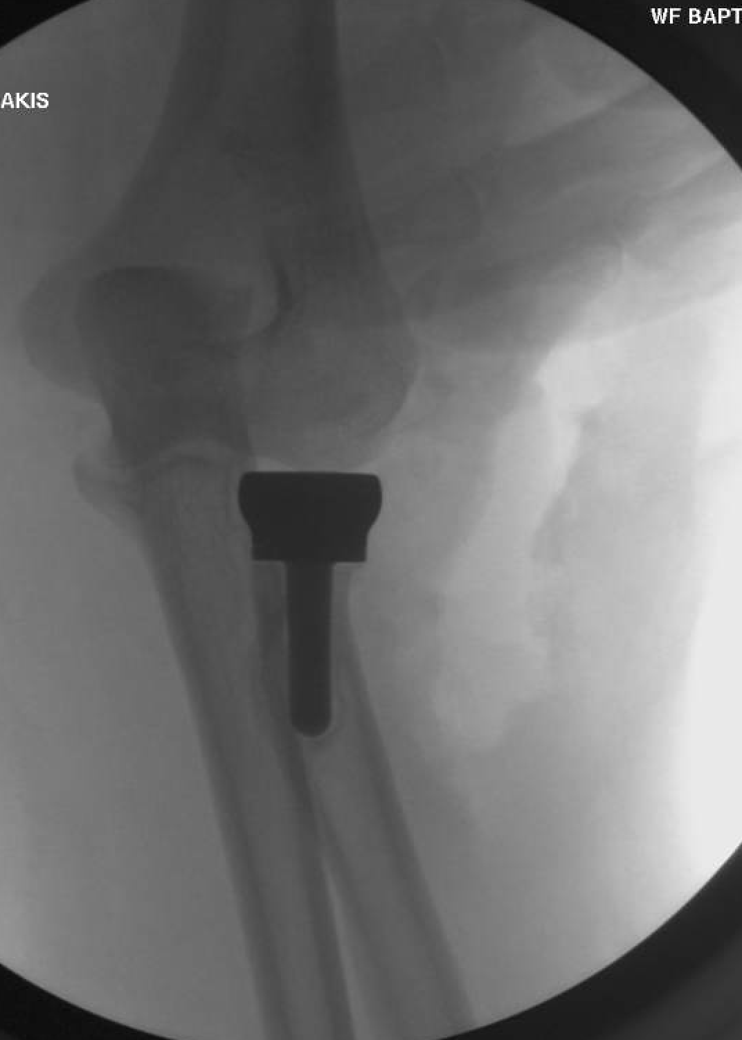 Shoulder and Elbow Surgery: Terrible triad injury. The importance of ...