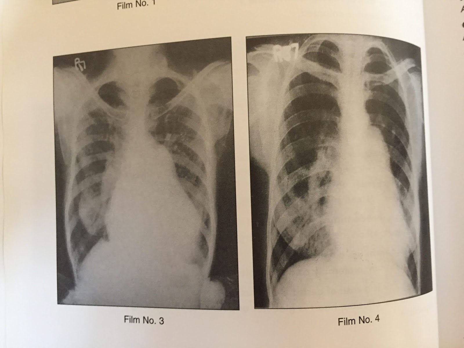 XRAYS OF SHUNT ANOMALY