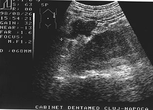 imagini splina Circulatie colaterala ecografie | Terapii naturiste si ...