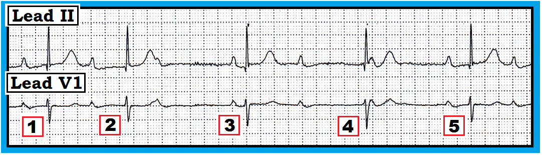 ECG Interpretation: ECG Interpretation Review #61 (AV Block – Mobitz I ...