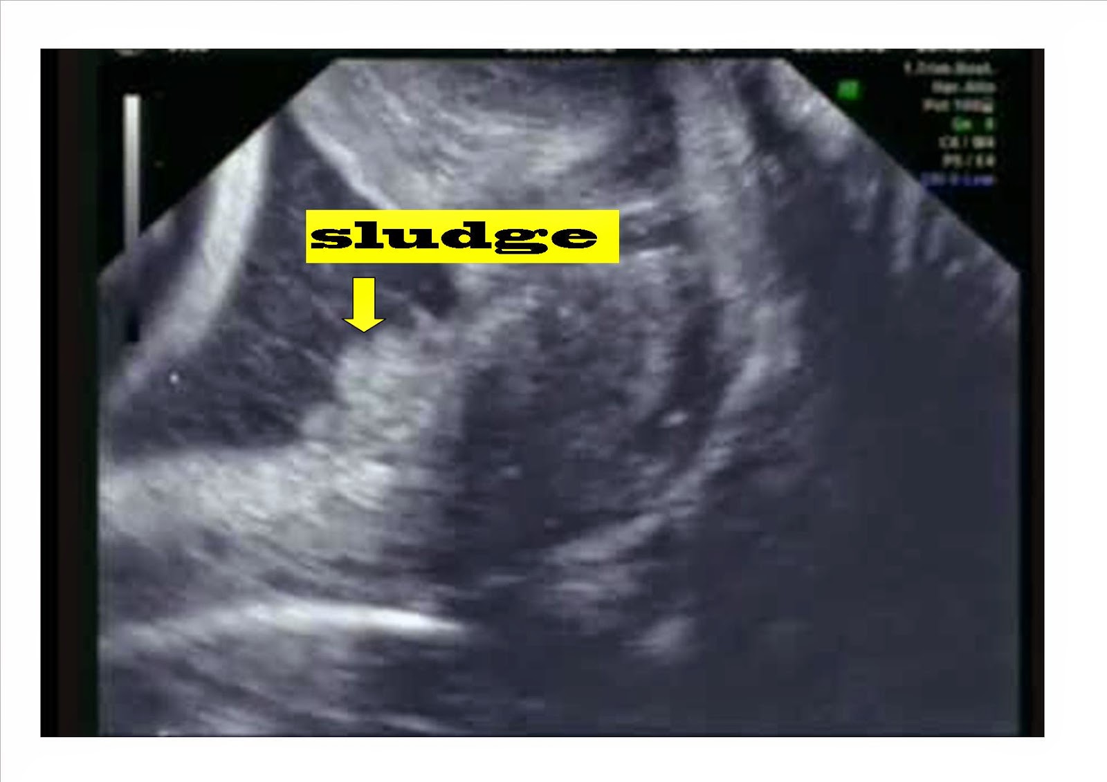 dudas gine: ¿Qué es el SLUDGE?