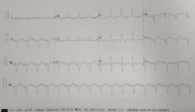 Cardiology window: Trifascicular block