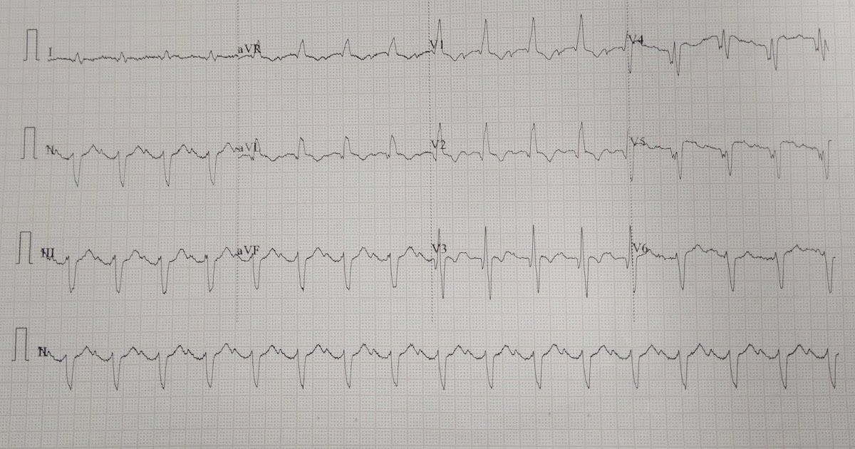 Cardiology window: Trifascicular block