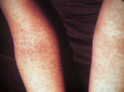 Kesehatan: Rumple Leed Test