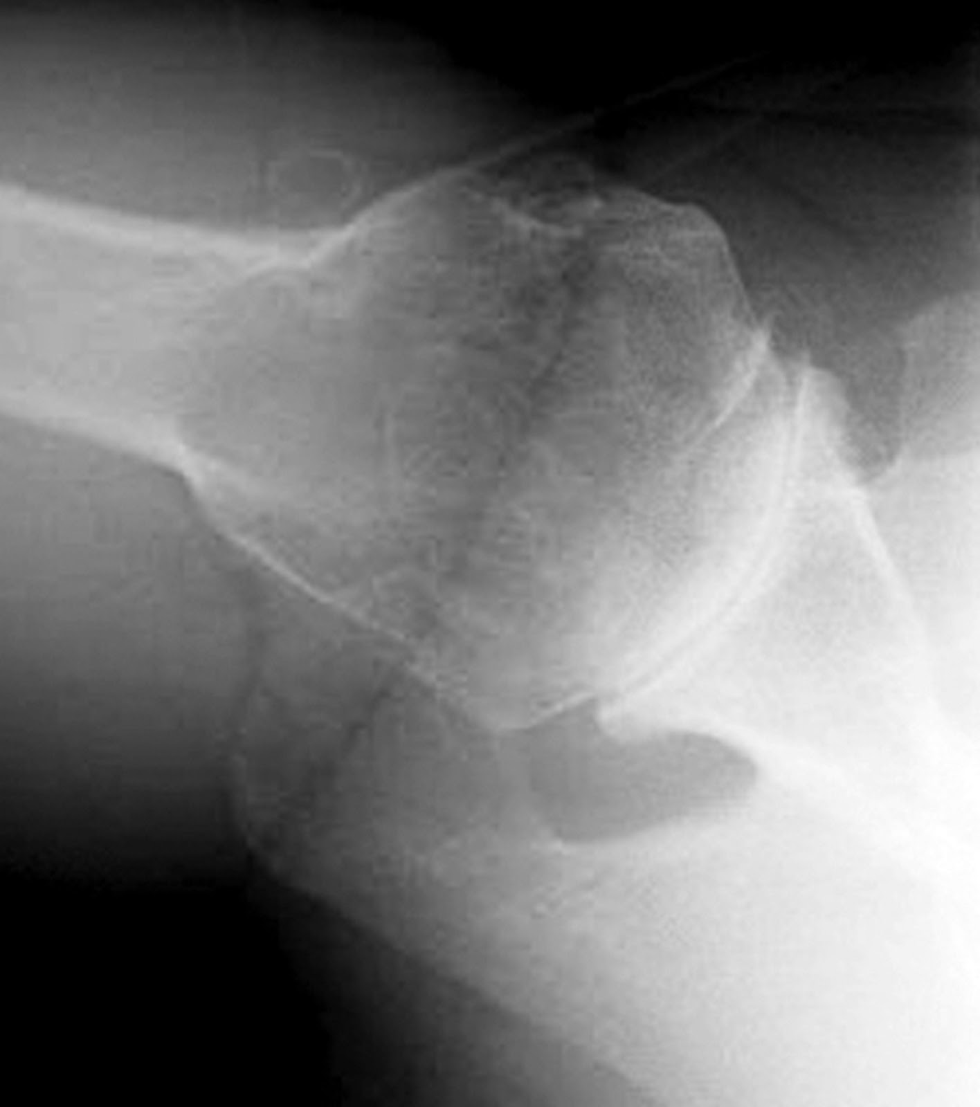 UW Shoulder and Elbow Academy: Glenoid type - Walch classification