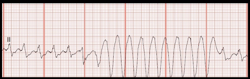 Practice EKG Rhythm Strips 189