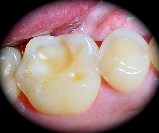 Blogs van Tandartspraktijk Top Dental: Tanderosie, een groter wordend ...