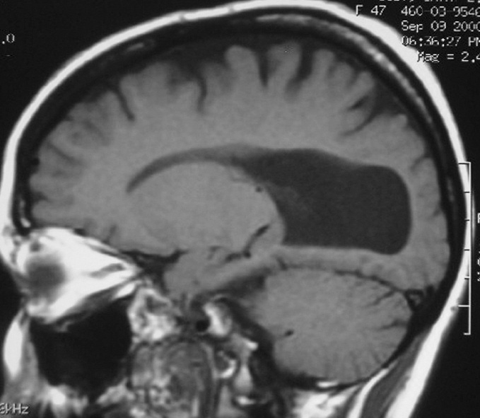I SAW SOMETHING NEW: Corpus Callosum Dysgenesis