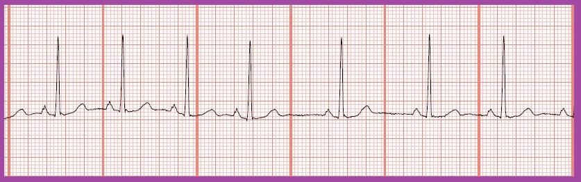 Characteristics of Sinus Rhythms