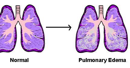 Pulmonary edema