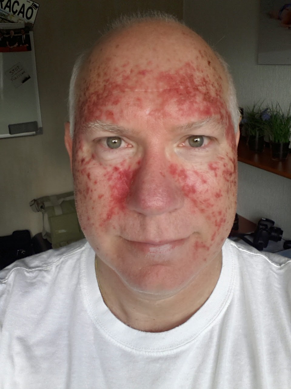 Resultaat gebruik Efudix: Algemeen