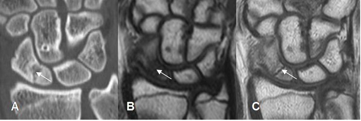 Fractura de escafoides | Medicusmeo