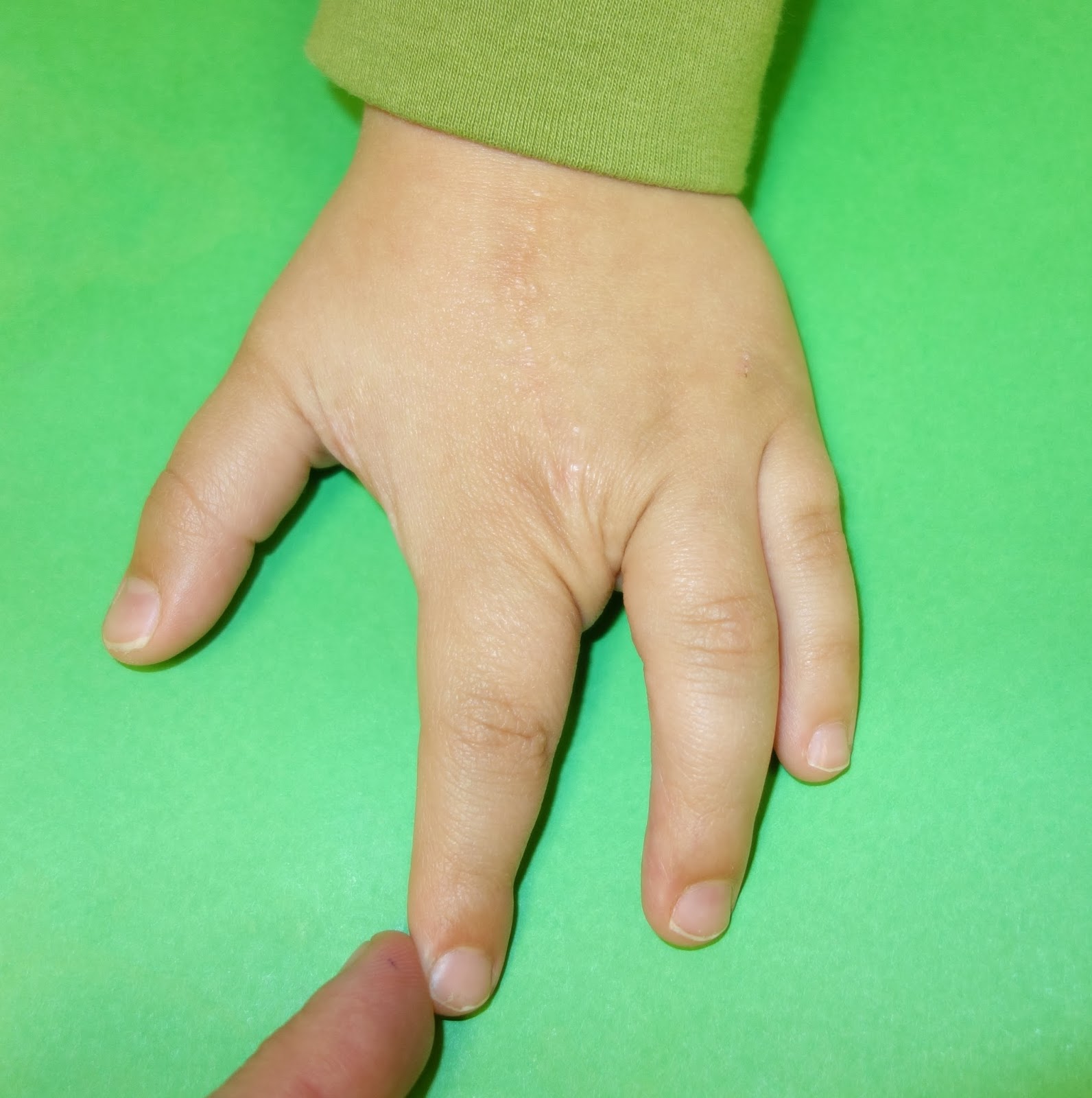 Challenges with Cleft Hand Reconstruction | Congenital Hand and Arm ...