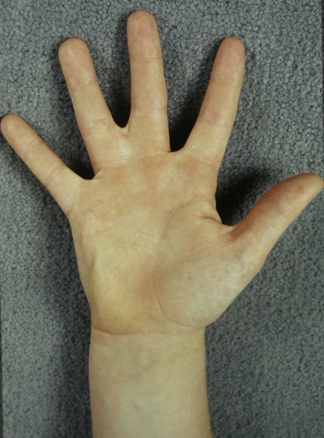 Partial Syndactyly | Congenital Hand and Arm Differences | Washington ...