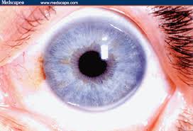 Lines from Leanna: Arcus Senilis and pressing on