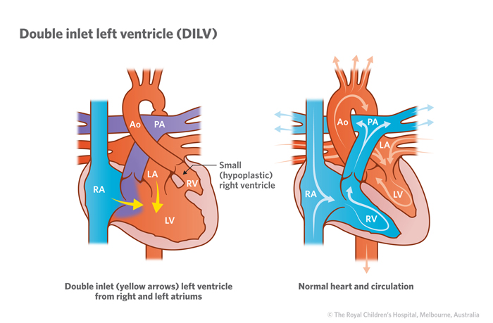 Living Whole Heartedly with Only Half a Heart: Double Inlet Left ...
