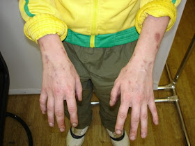Deformutilation: Desomorphine aka Krokodil II