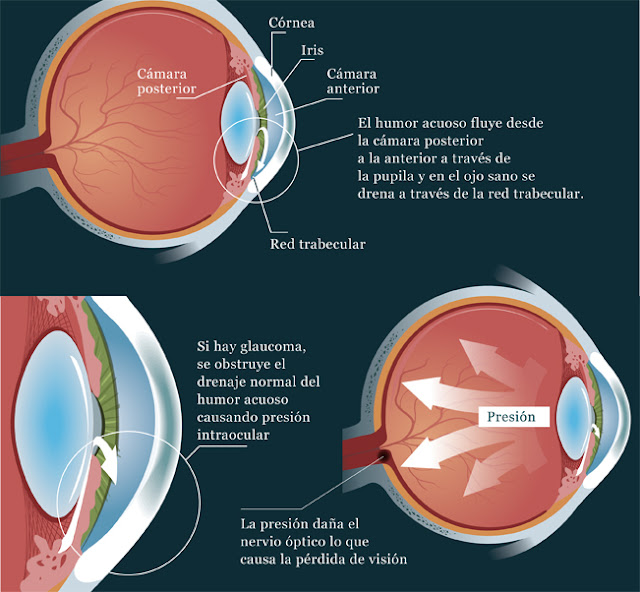 Glaucoma
