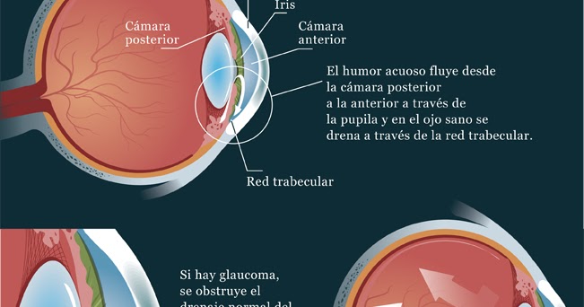 Glaucoma