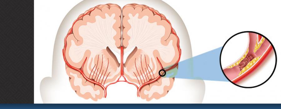 An Insight Into Life Stroke An Insight Into Life Stroke