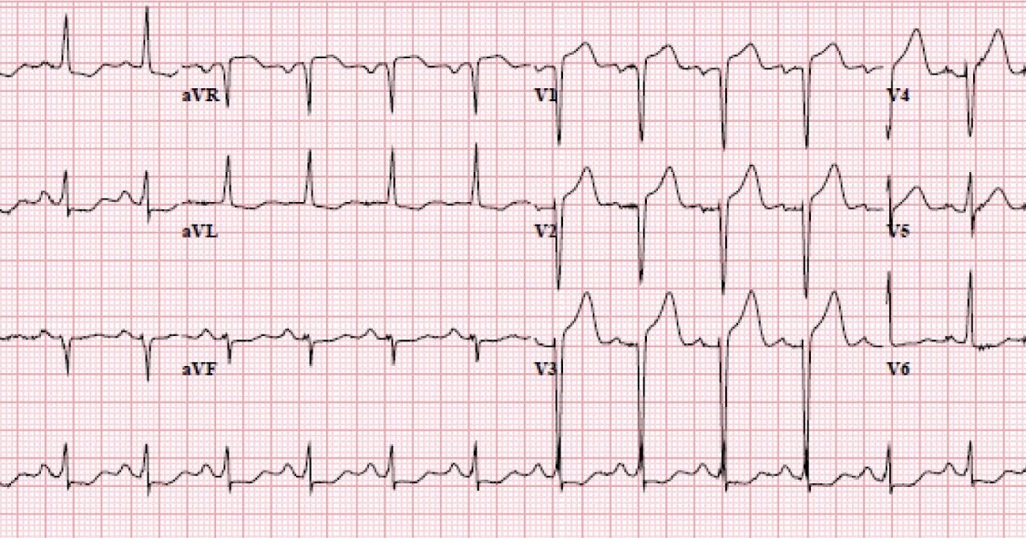 Dr. Smith's ECG Blog: LVH with anterior ST Elevation. When is it ...