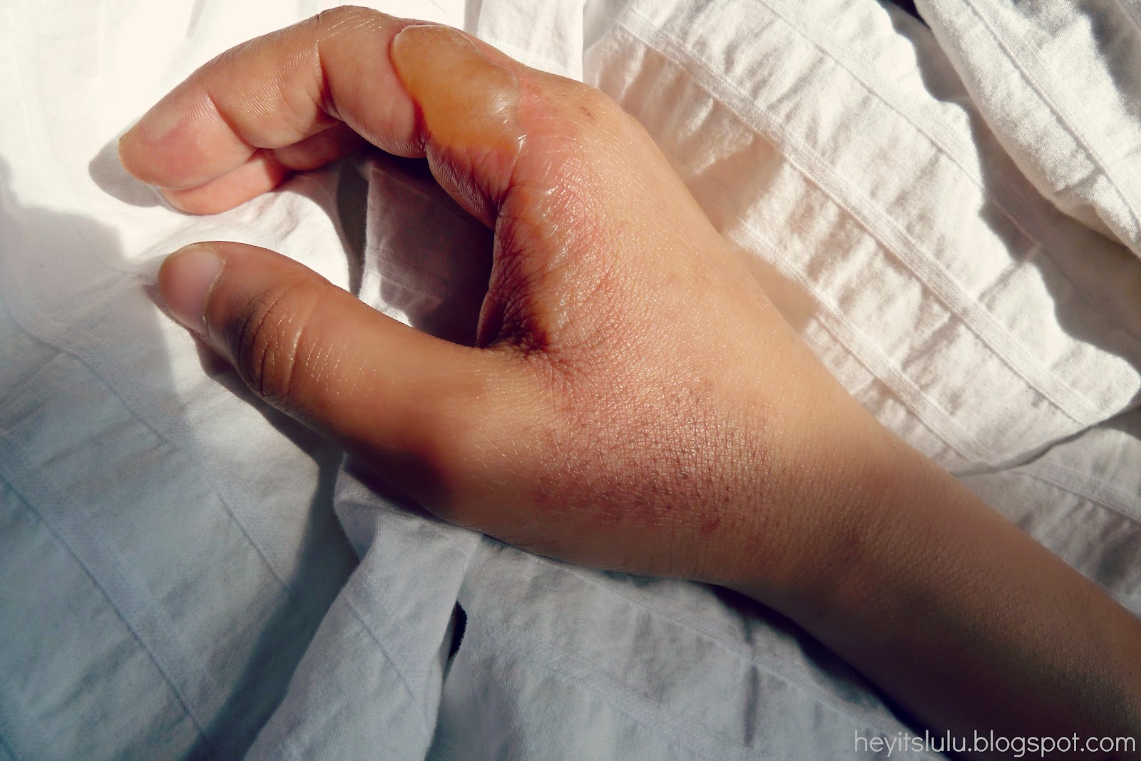 How I Treated My Burn (UPDATED)