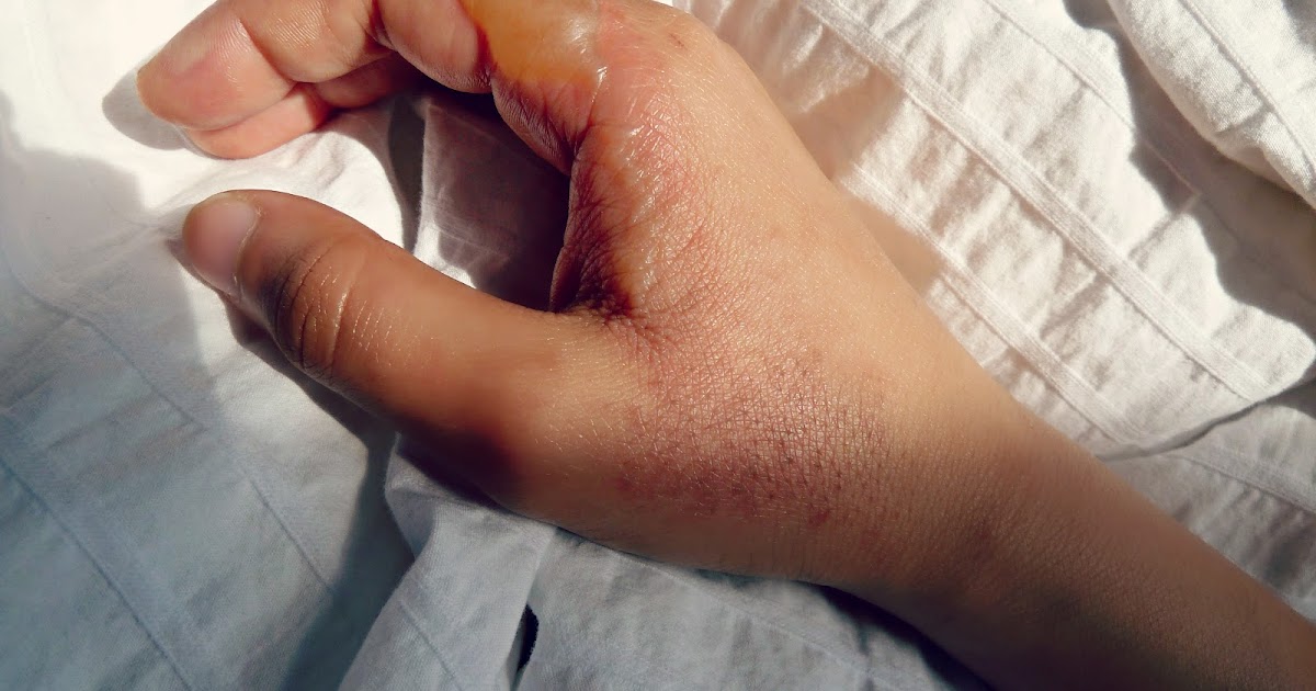 How I Treated My Burn (UPDATED)