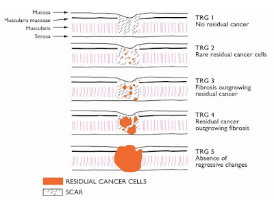 Radiotherapy Dictionary: TRG (tumor regression grade) in esophageal ...