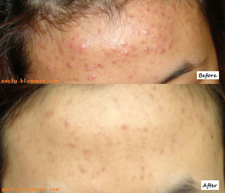 PSCLY: Acne and Proactiv Solution