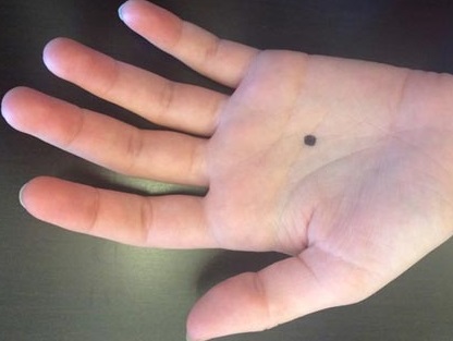 Photos of Moles on Hand Arm and Leg ~ How To Remove Moles, Warts, Skin ...