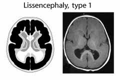 Medical Treatment Pictures-for Better Understanding: Lissencephaly