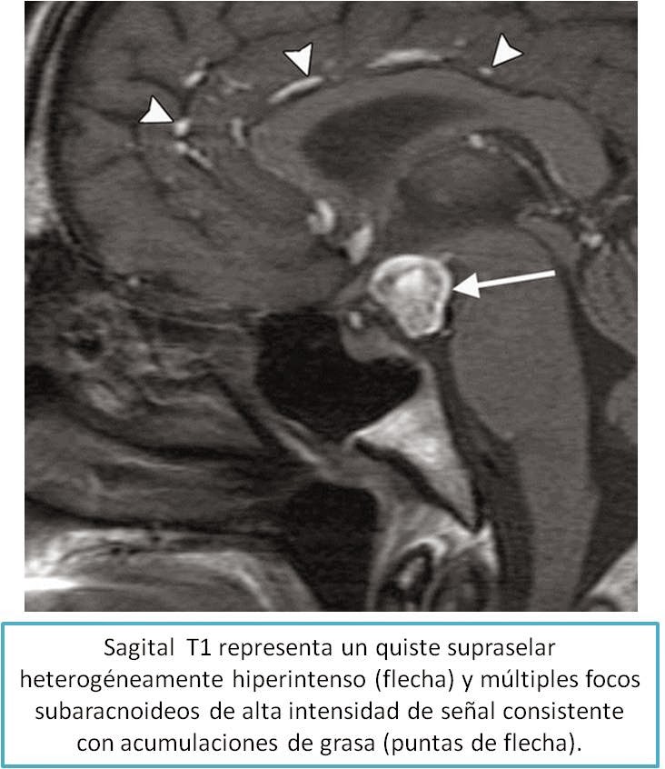 ESPE 203-2013: Patología de región selar: rol de imagenología