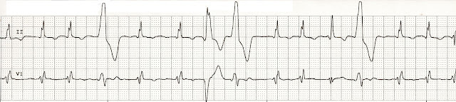 EKG Rhythm Strip Quiz 47