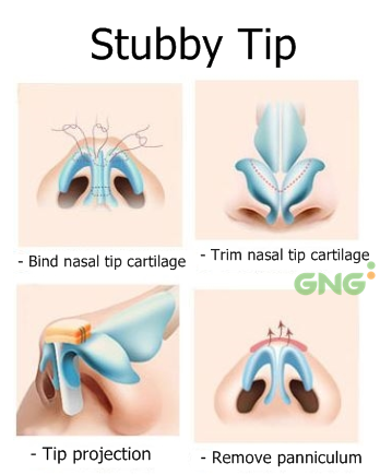 GNG Plastic Surgery Hospital: Who Needs Bulbous Nose Rhinoplasty?