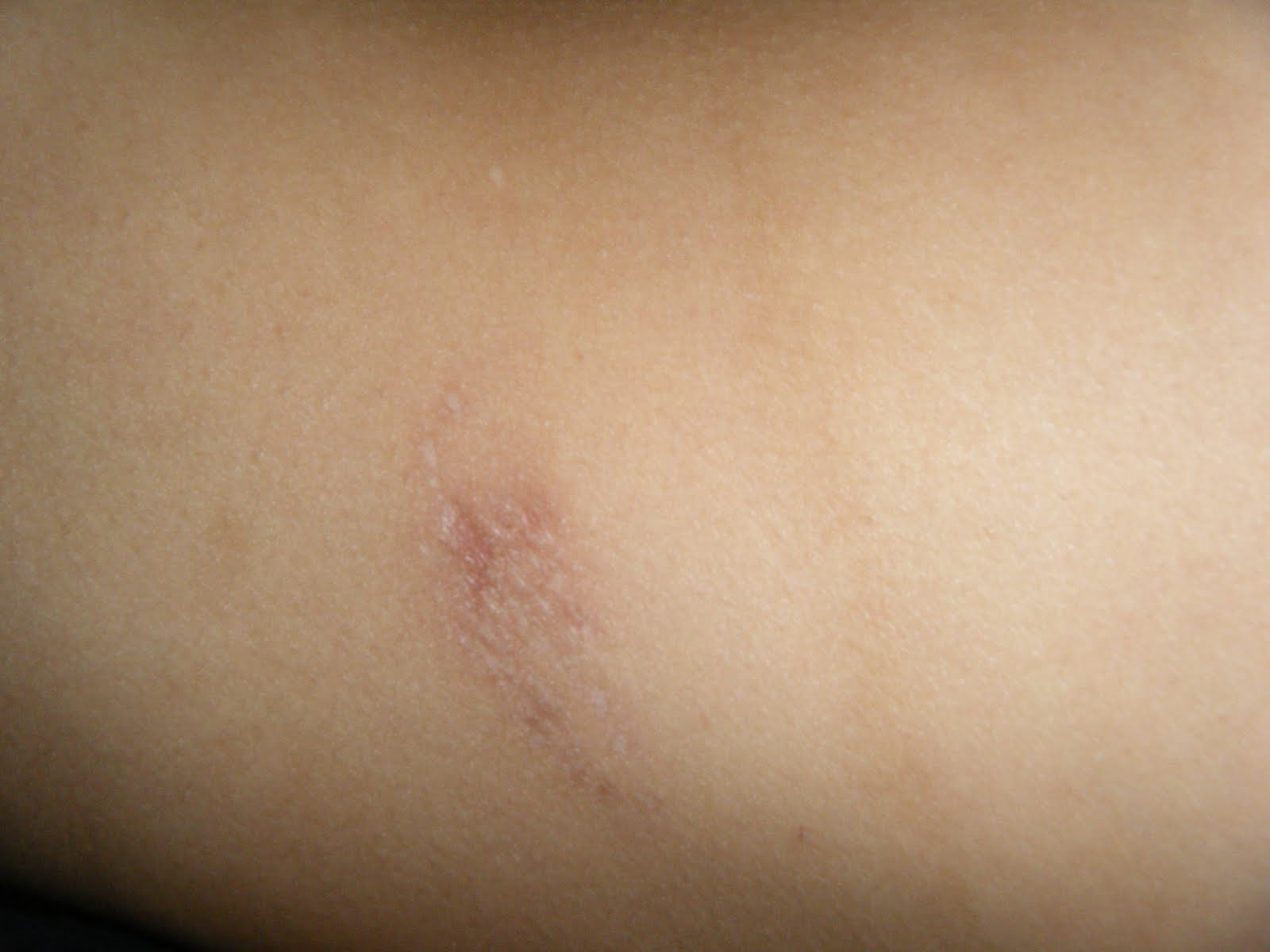 21 and Shingles: Shingles scars