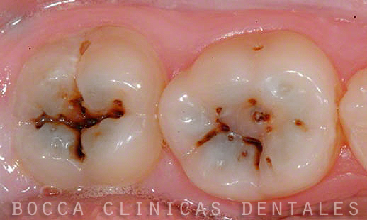 BOCCA CLINICAS DENTALES: CARIES: Definición..