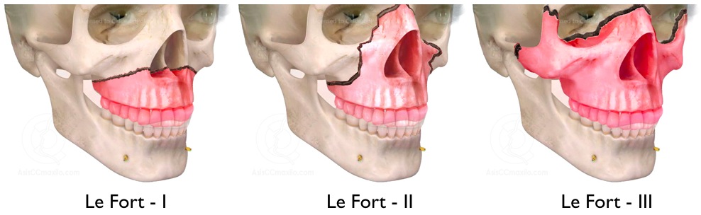 Fratura De Lefort Iii Le Fort III Osteotomy An Overview