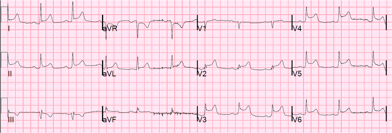 Dr. Smith's ECG Blog: Pericarditis, or Anterior STEMI? The QRS proves it.