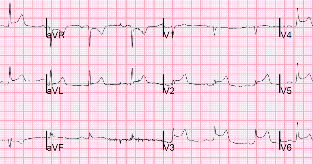 Dr. Smith's ECG Blog: Pericarditis, or Anterior STEMI? The QRS proves it.