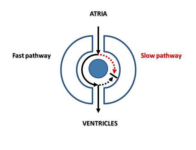 ECG Channel: AV Nodal Reentry Tachycardia