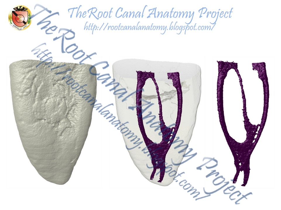 The Root Canal Anatomy Project: Middle Mesial Canal - Mandibular Molar