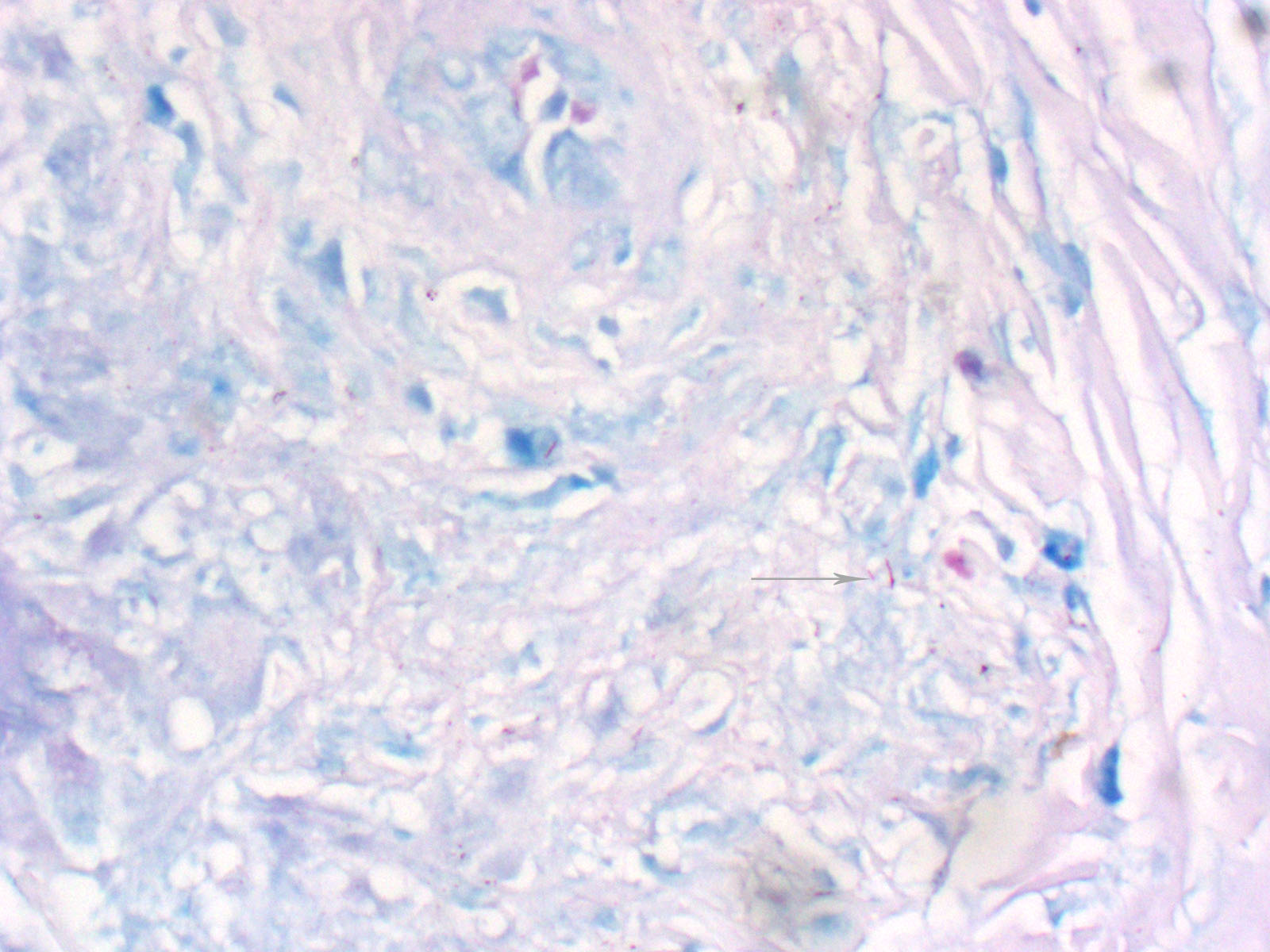 VIRTUAL GRAND ROUNDS IN DERMATOLOGY 2.0: 65 yo woman with nodulo ...