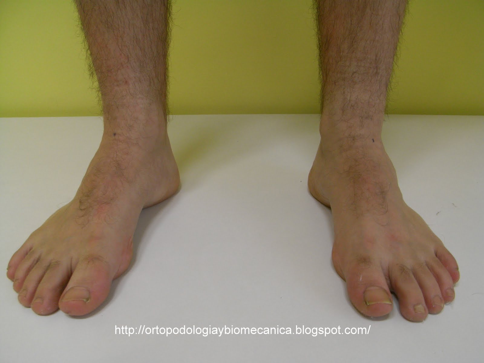 Ortopodologia y Biomecanica : “GAIT PLATE”. TRATAMIENTO METATARSO ADUCTO