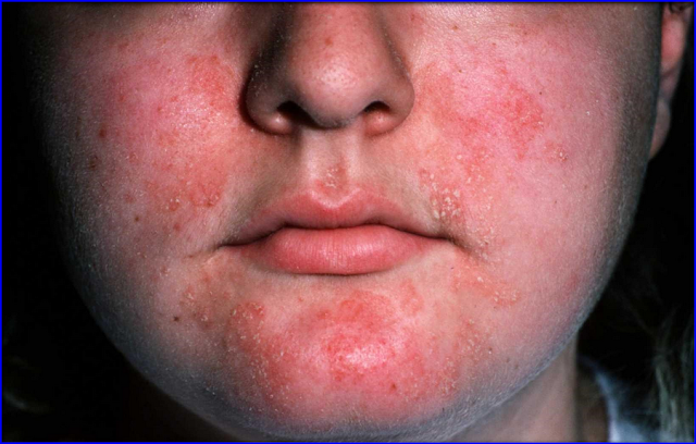 Seborrheic Dermatitis Pictures on Scalp, Face, and Infant’s Body and ...