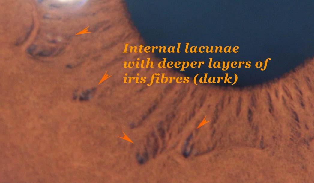Modern & Multidimensional Iridology: Crypts, Internal Lacunae ...