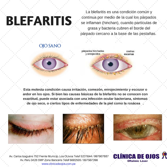 Clínica de Ojos Oftalmic Láser: BLEFARITIS