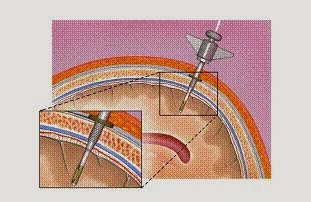 L'hypertension intracrânienne (HTIC) | Récap' IDE